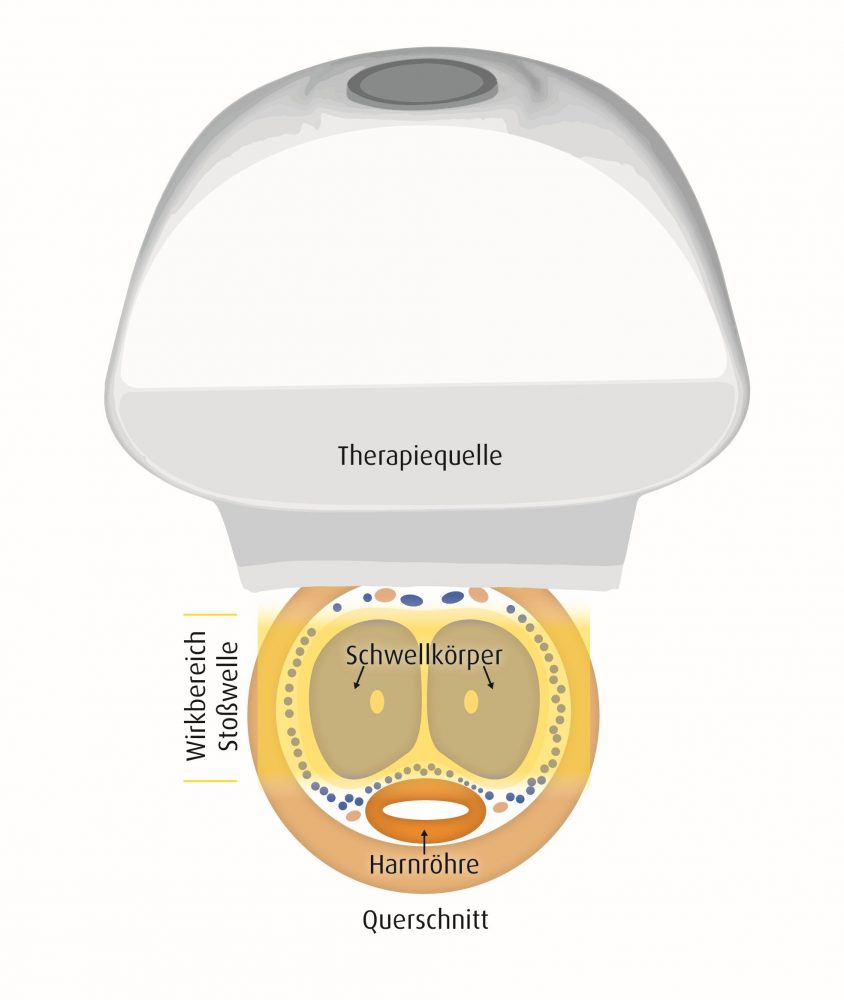 Fokussierte Stoßwelle PiezoWave² zur Behandlung der Erektilen Dysfunktion - Schuhfried ...